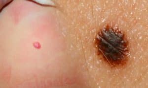 Nevo di Spitz: Cos'è, Cause, Istologia, è Pericoloso?