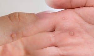Verruche: Cosa sono, Come Riconoscerle e Come Eliminarle