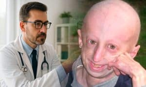 Sindrome di Cockayne: si può Curare o Conduce alla Morte?