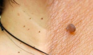 Fibromi Penduli: Cosa Sono, Cause e Come Eliminarli